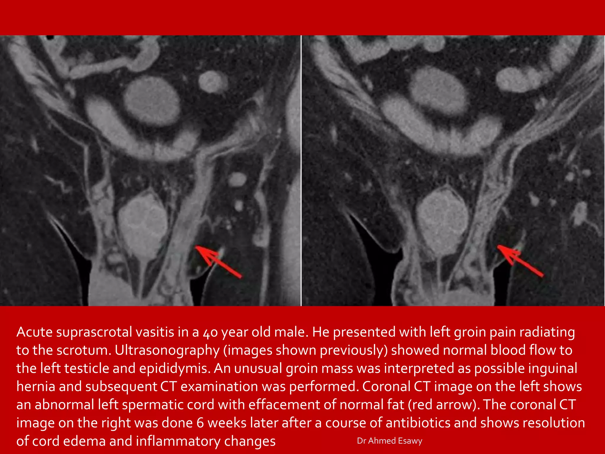 Imaging vastitis differentitis funiculitis seminal vesiculitis Dr Ahmed ...