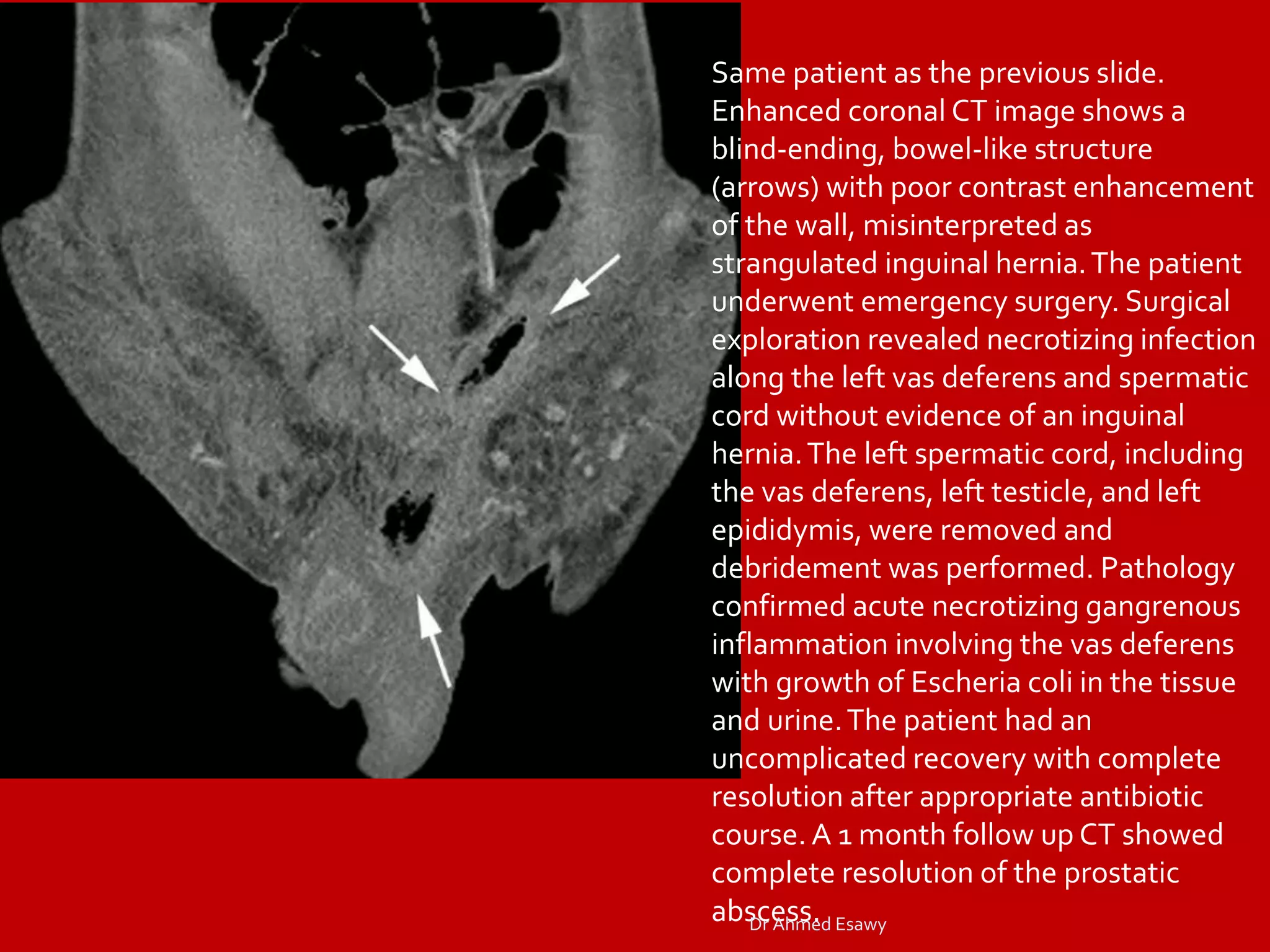 Imaging vastitis differentitis funiculitis seminal vesiculitis Dr Ahmed ...