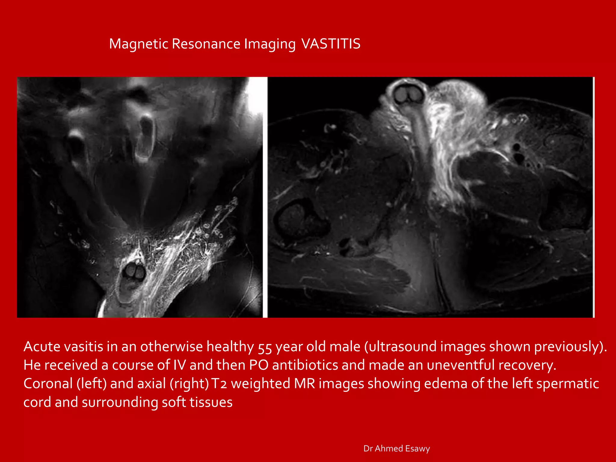 Imaging vastitis differentitis funiculitis seminal vesiculitis Dr Ahmed ...