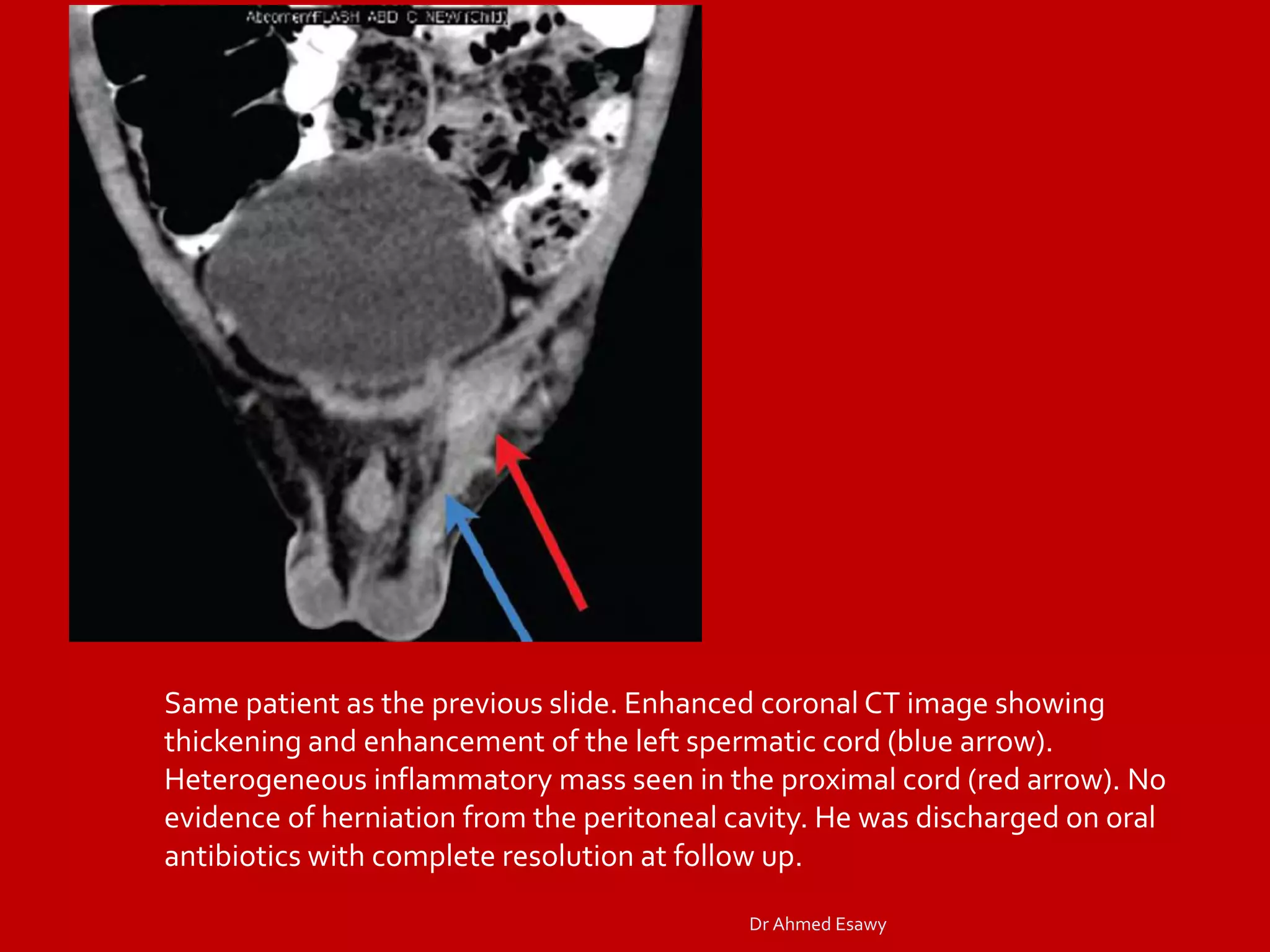 Imaging vastitis differentitis funiculitis seminal vesiculitis Dr Ahmed ...
