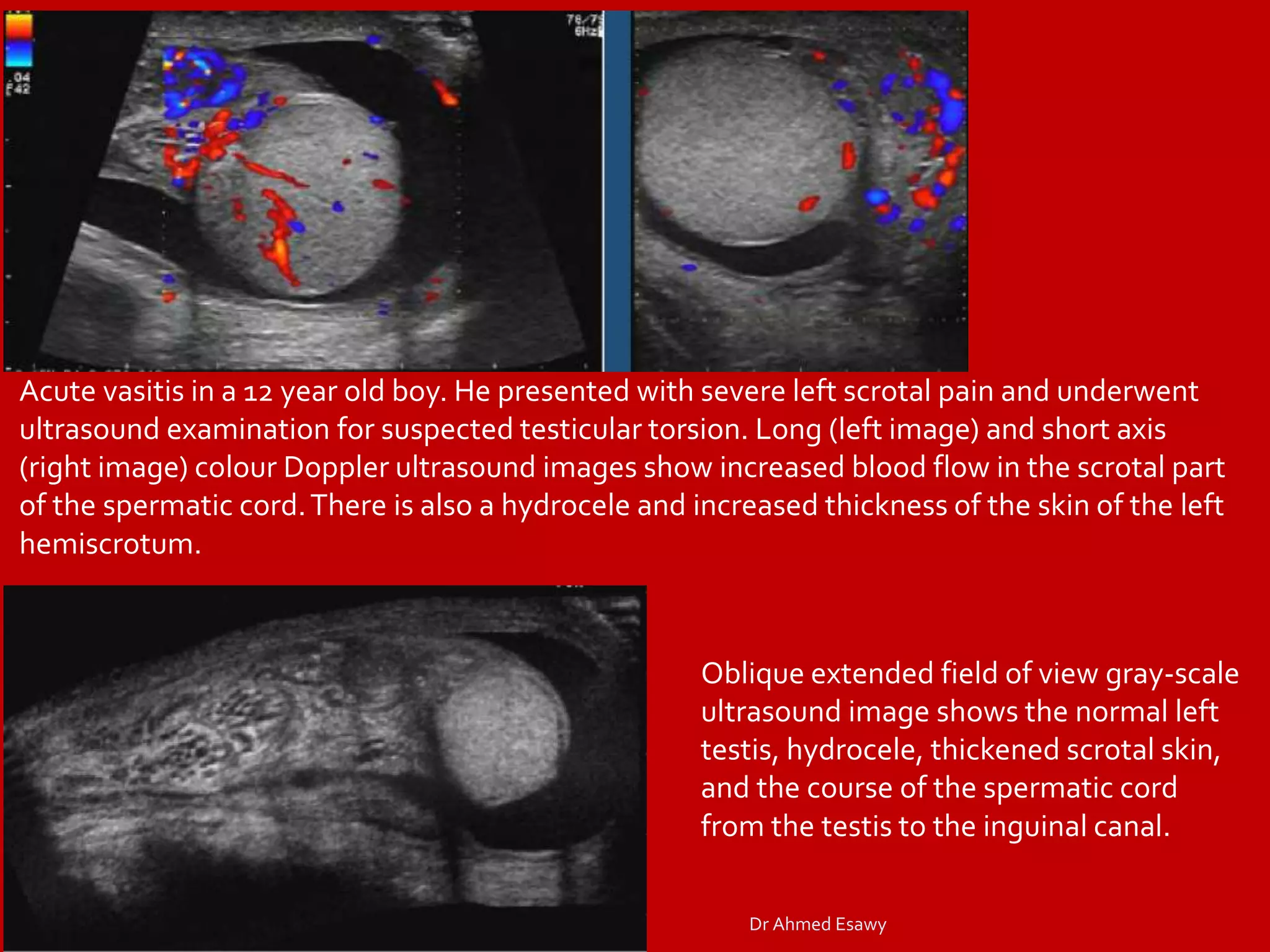 Imaging vastitis differentitis funiculitis seminal vesiculitis Dr Ahmed ...