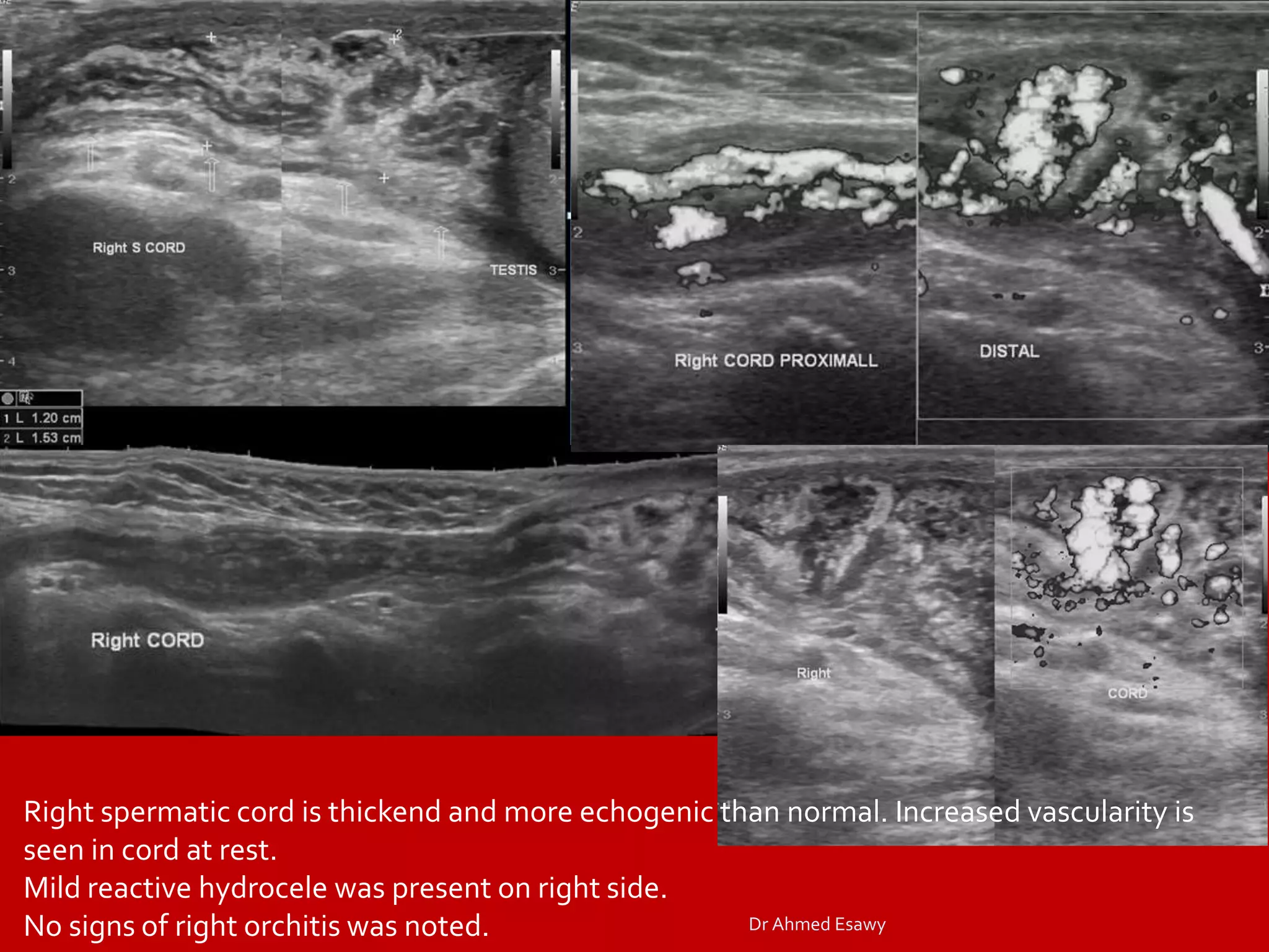 Imaging vastitis differentitis funiculitis seminal vesiculitis Dr Ahmed ...