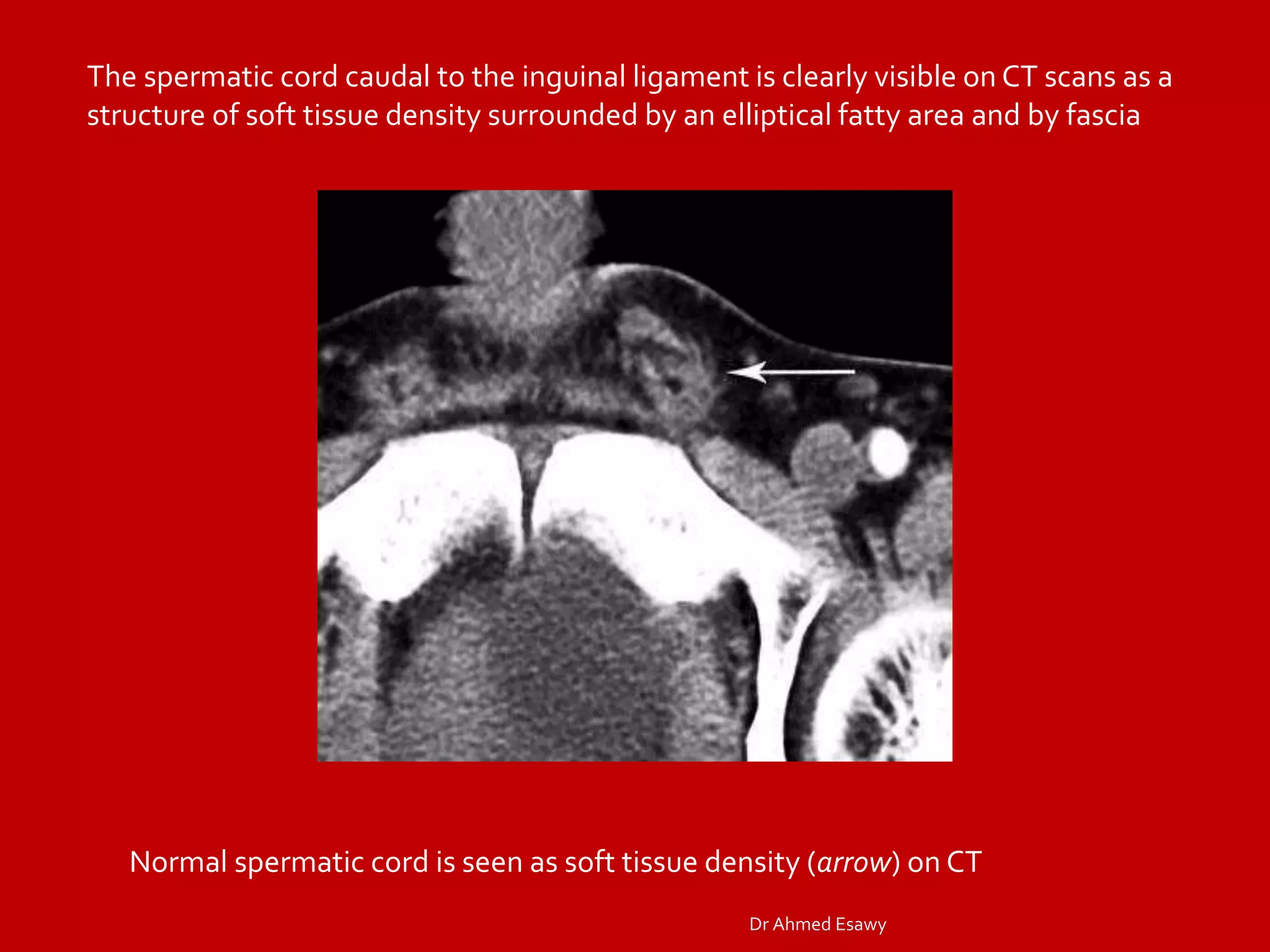 Imaging vastitis differentitis funiculitis seminal vesiculitis Dr Ahmed ...
