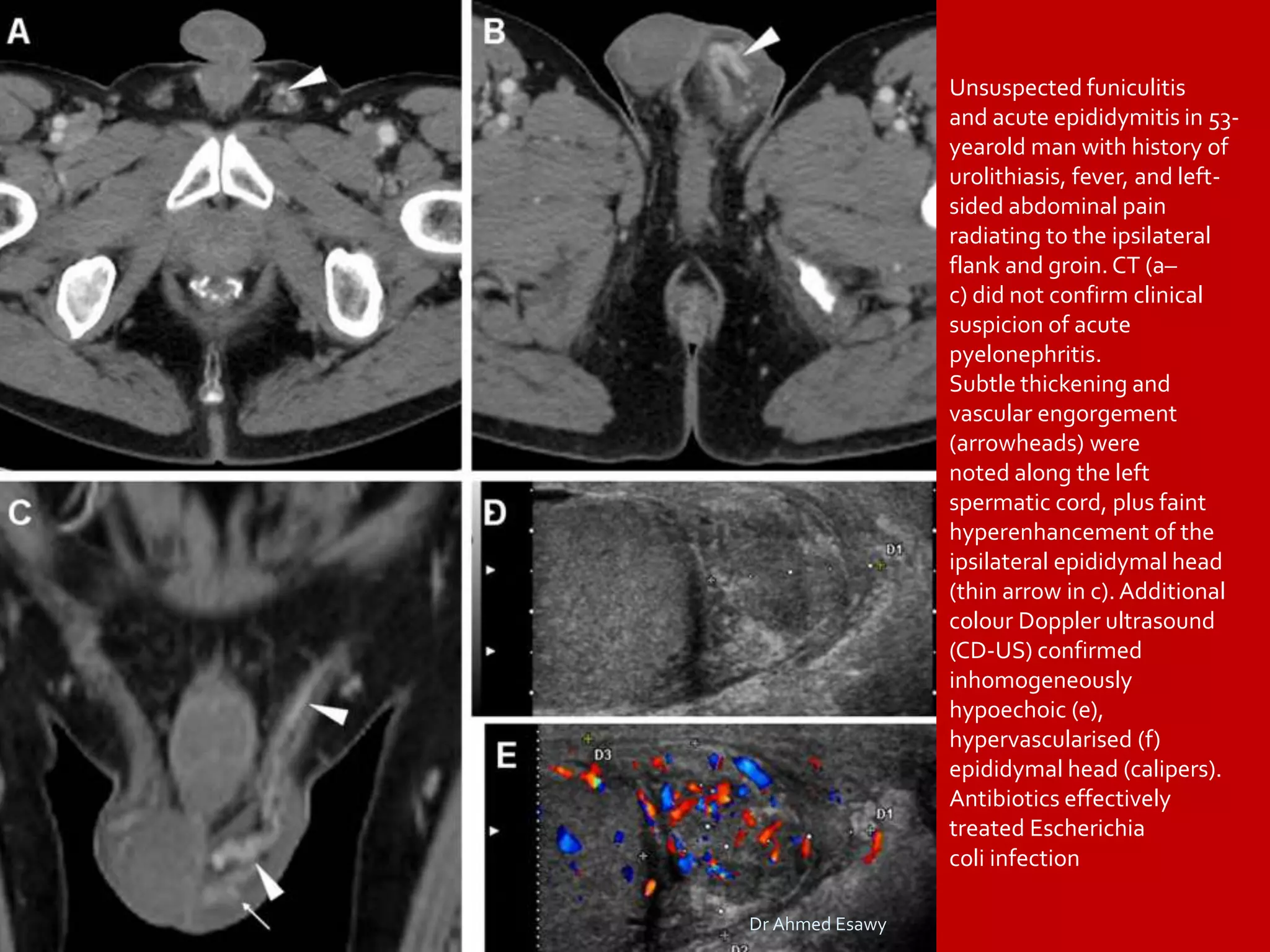 Imaging vastitis differentitis funiculitis seminal vesiculitis Dr Ahmed ...