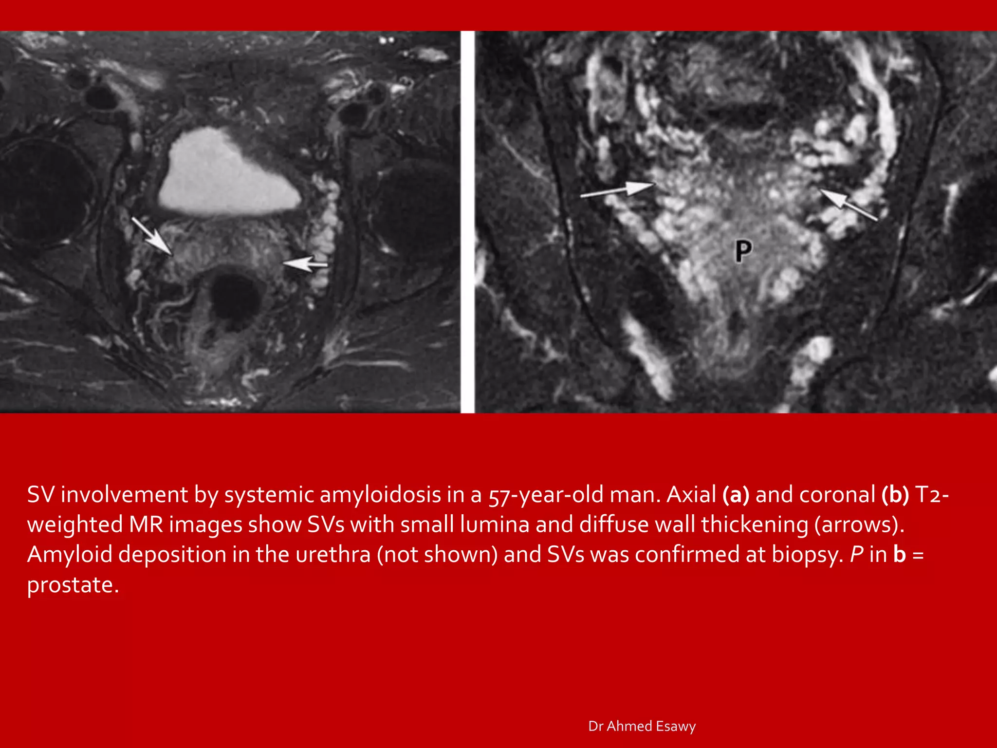 Imaging vastitis differentitis funiculitis seminal vesiculitis Dr Ahmed ...