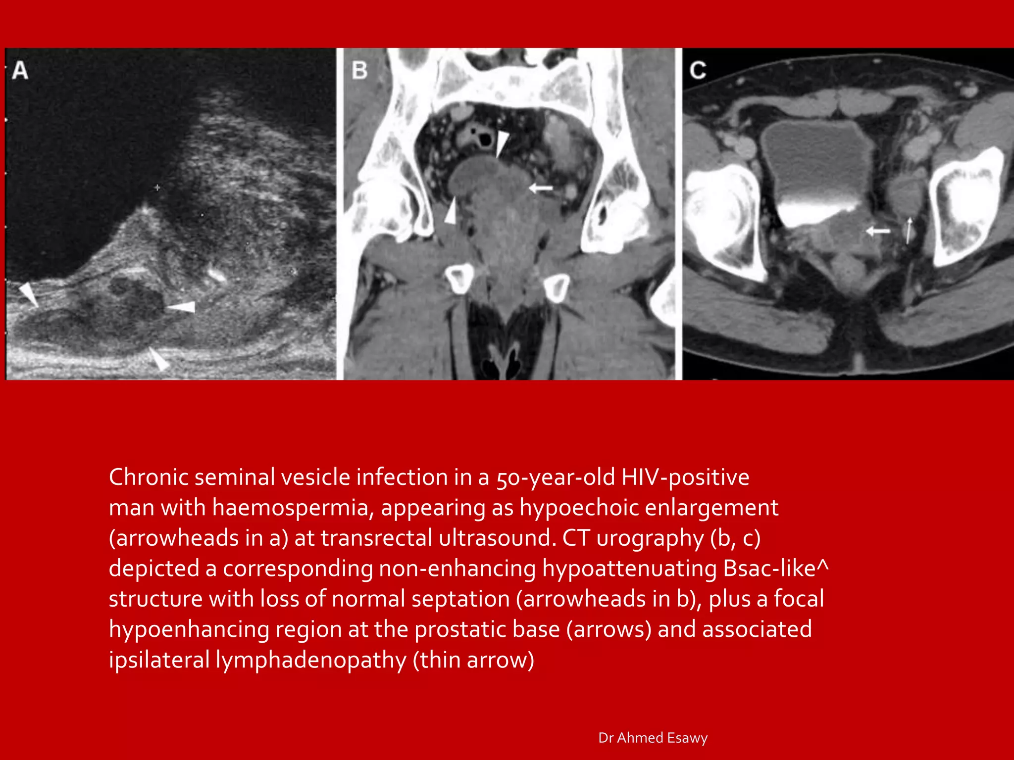 Imaging vastitis differentitis funiculitis seminal vesiculitis Dr Ahmed ...