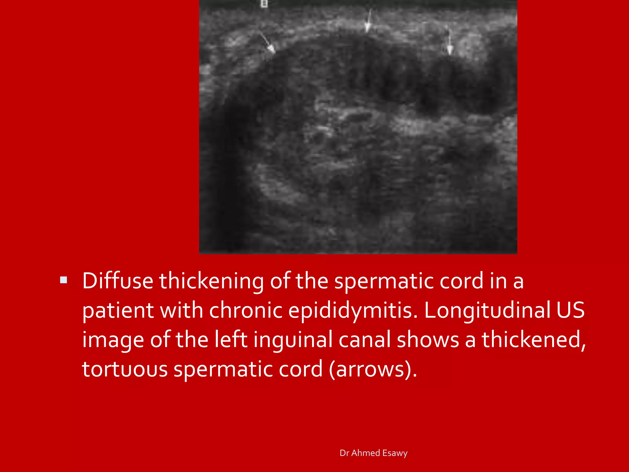 Imaging vastitis differentitis funiculitis seminal vesiculitis Dr Ahmed ...