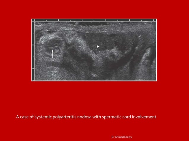 Imaging vastitis differentitis funiculitis seminal vesiculitis Dr Ahmed ...