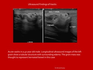 Imaging vastitis differentitis funiculitis seminal vesiculitis Dr Ahmed ...
