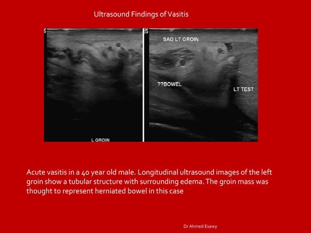 Imaging vastitis differentitis funiculitis seminal vesiculitis Dr Ahmed ...