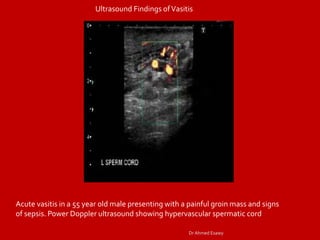 Imaging vastitis differentitis funiculitis seminal vesiculitis Dr Ahmed ...