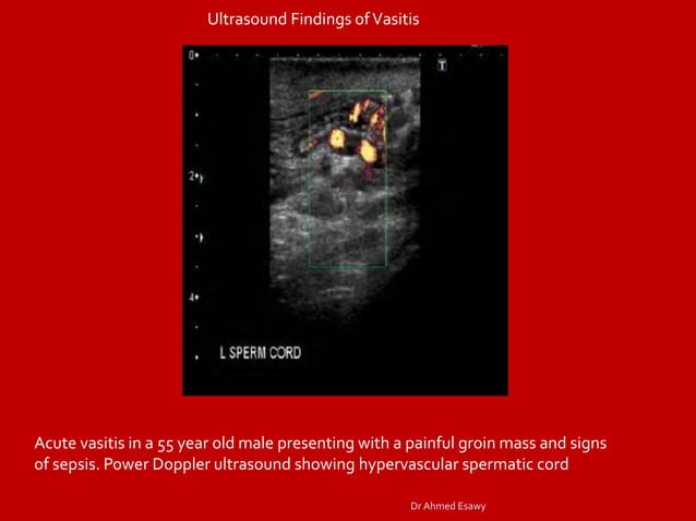 Imaging vastitis differentitis funiculitis seminal vesiculitis Dr Ahmed ...