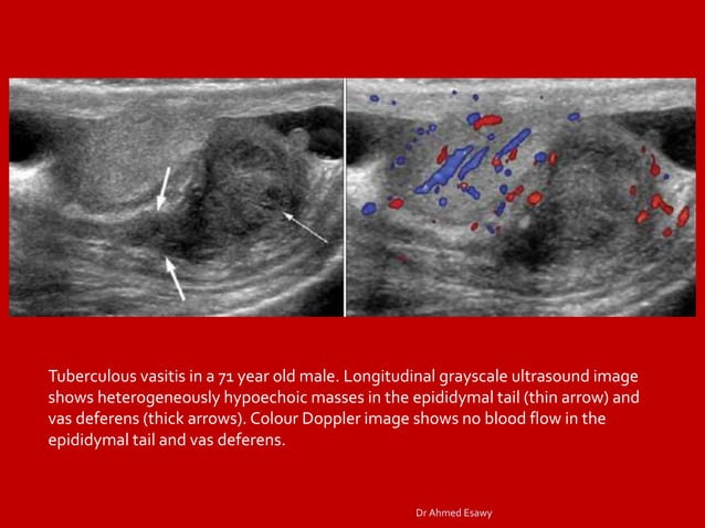 Imaging vastitis differentitis funiculitis seminal vesiculitis Dr Ahmed ...
