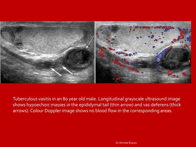 Imaging vastitis differentitis funiculitis seminal vesiculitis Dr Ahmed ...