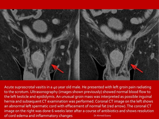 Imaging vastitis differentitis funiculitis seminal vesiculitis Dr Ahmed ...
