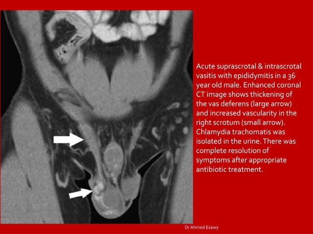 Imaging vastitis differentitis funiculitis seminal vesiculitis Dr Ahmed ...