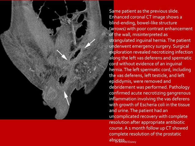 Imaging vastitis differentitis funiculitis seminal vesiculitis Dr Ahmed ...