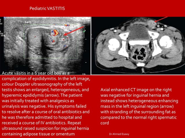 Imaging vastitis differentitis funiculitis seminal vesiculitis Dr Ahmed ...