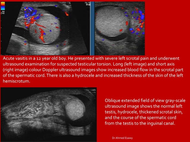 Imaging vastitis differentitis funiculitis seminal vesiculitis Dr Ahmed ...