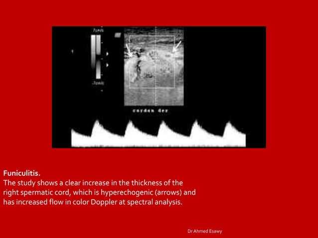 Imaging vastitis differentitis funiculitis seminal vesiculitis Dr Ahmed ...