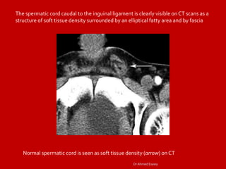 Imaging vastitis differentitis funiculitis seminal vesiculitis Dr Ahmed ...