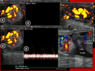 Imaging vastitis differentitis funiculitis seminal vesiculitis Dr Ahmed ...