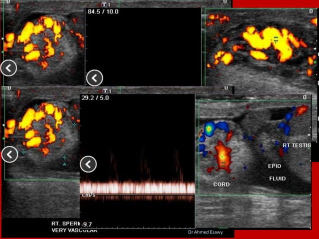 Imaging vastitis differentitis funiculitis seminal vesiculitis Dr Ahmed ...