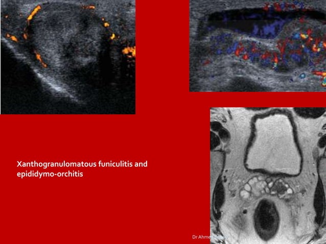 Imaging vastitis differentitis funiculitis seminal vesiculitis Dr Ahmed ...