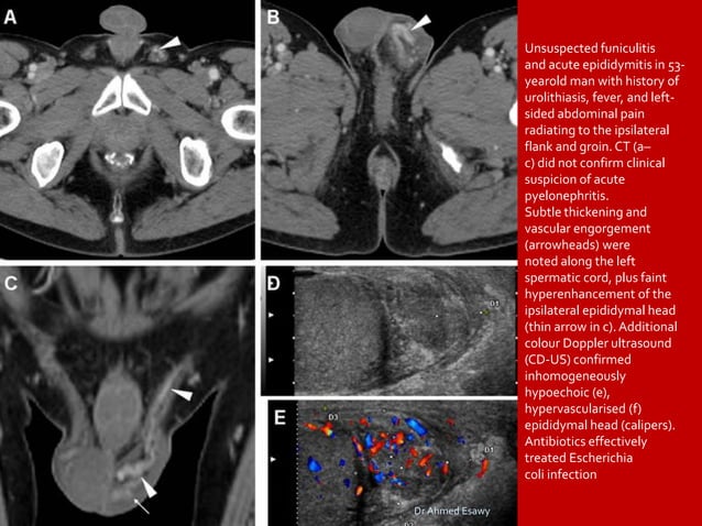 Imaging vastitis differentitis funiculitis seminal vesiculitis Dr Ahmed ...