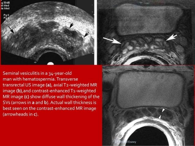 Imaging vastitis differentitis funiculitis seminal vesiculitis Dr Ahmed ...