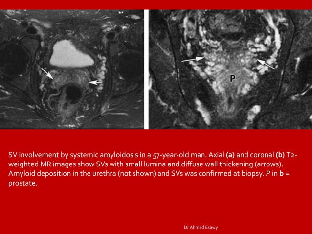 Imaging vastitis differentitis funiculitis seminal vesiculitis Dr Ahmed ...