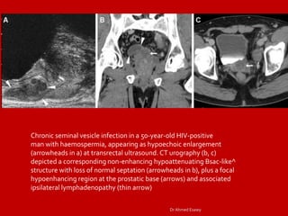 Imaging vastitis differentitis funiculitis seminal vesiculitis Dr Ahmed ...