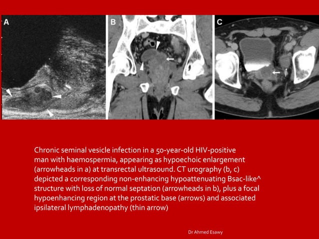 Imaging vastitis differentitis funiculitis seminal vesiculitis Dr Ahmed ...
