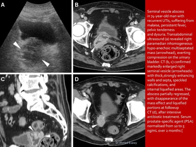 Imaging vastitis differentitis funiculitis seminal vesiculitis Dr Ahmed ...