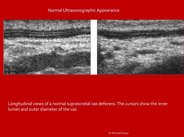 Imaging vastitis differentitis funiculitis seminal vesiculitis Dr Ahmed ...
