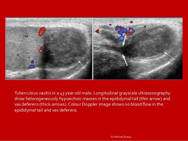 Imaging vastitis differentitis funiculitis seminal vesiculitis Dr Ahm…