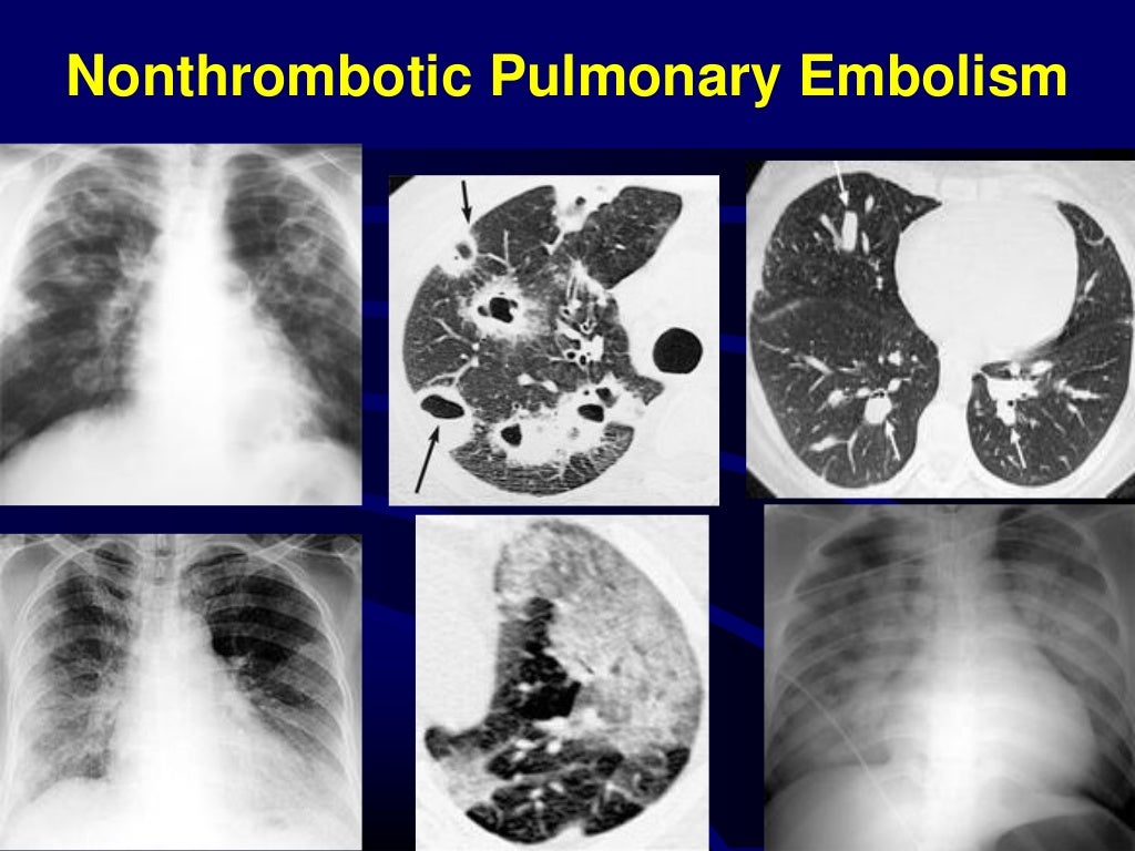 Imaging of Pulmonary Embolism