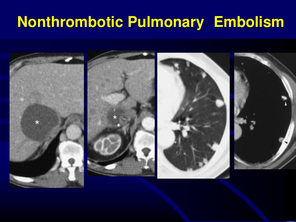 Imaging of Pulmonary Embolism