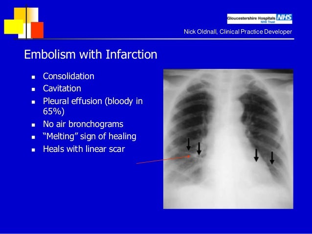 Imaging of Pulmonary Embolism