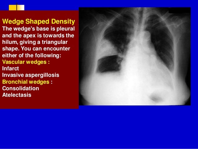 Imaging of Pulmonary Embolism
