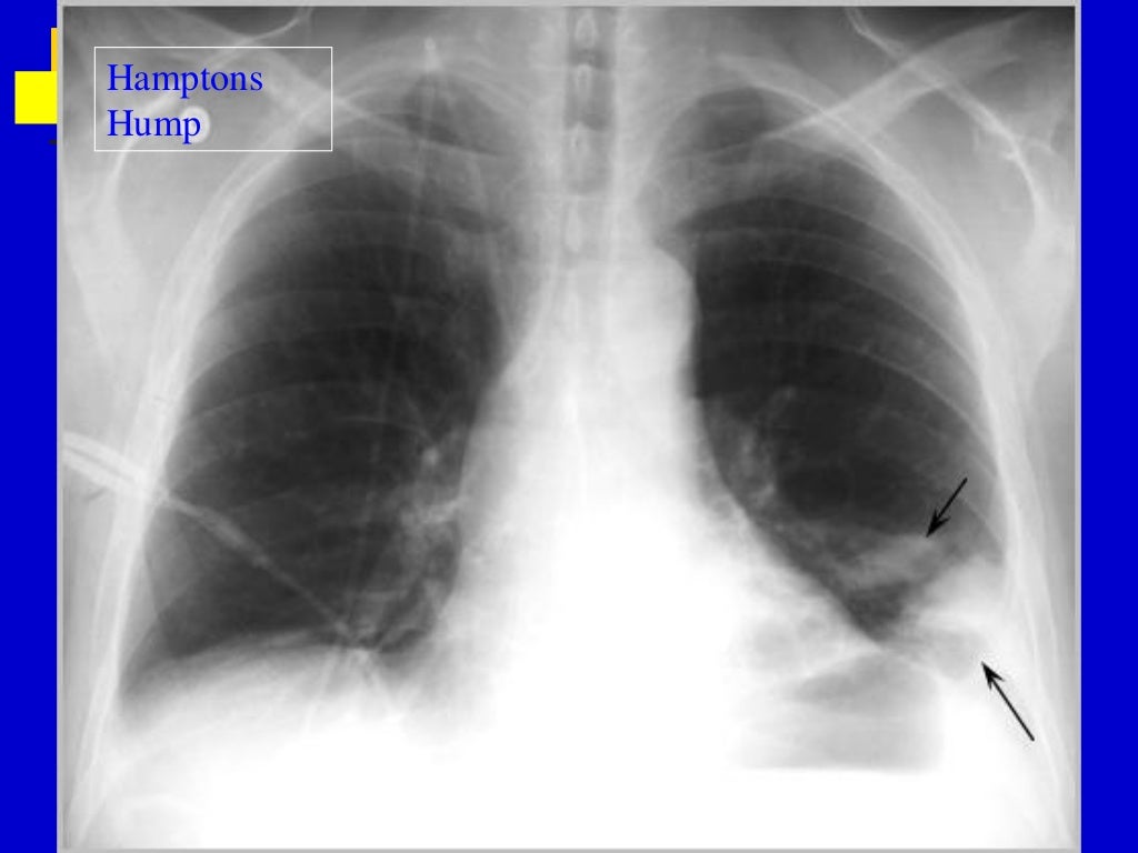 Imaging of Pulmonary Embolism