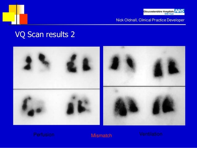 Imaging of Pulmonary Embolism