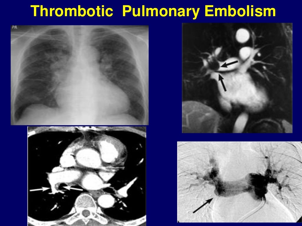 Imaging of Pulmonary Embolism