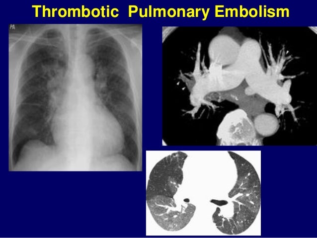 Imaging of Pulmonary Embolism