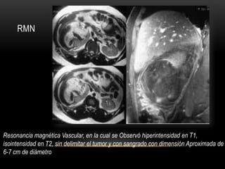 hematoma retroperitoneal | PPTX