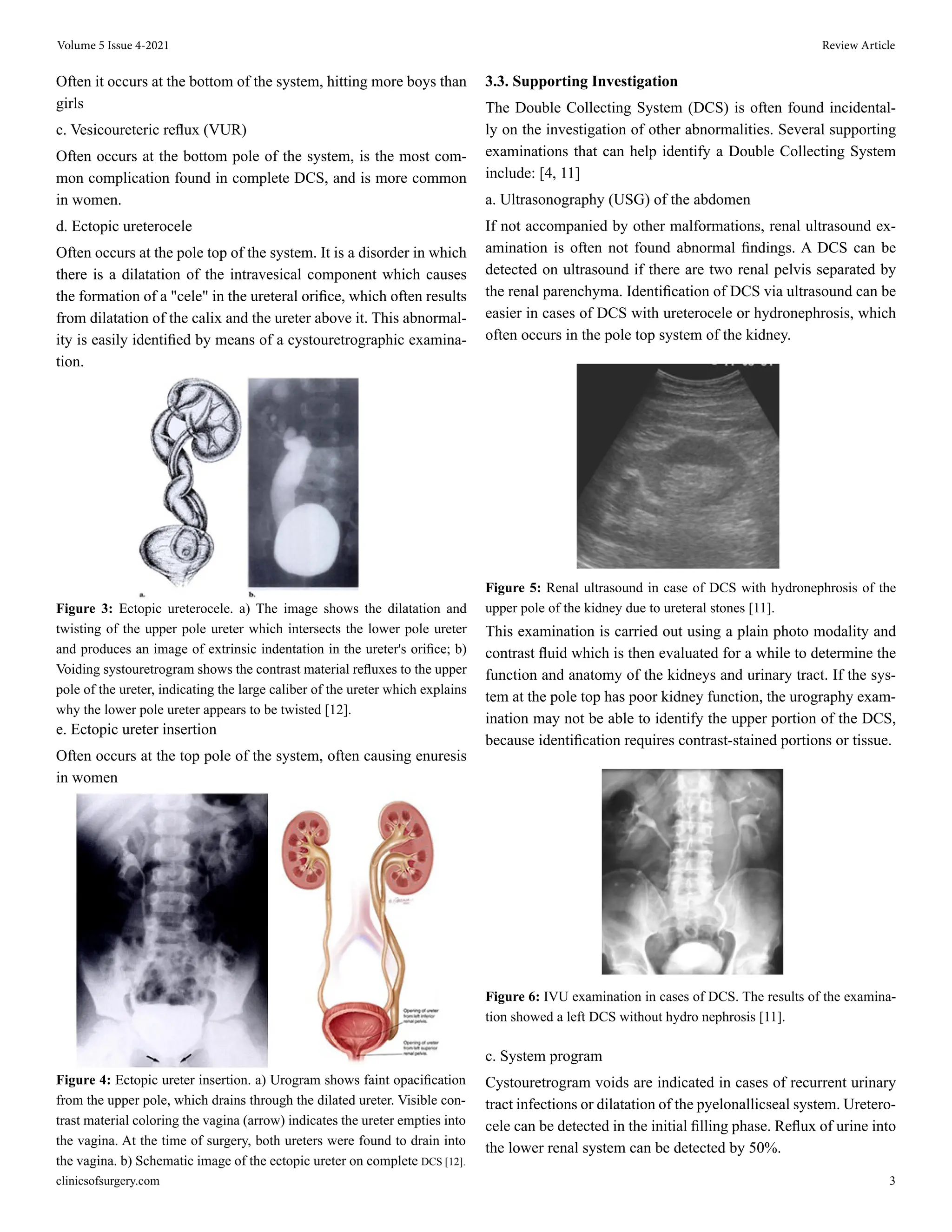 Double Collecting System, A Rare Disease Diagnosis and Management: A Review Article | PDF