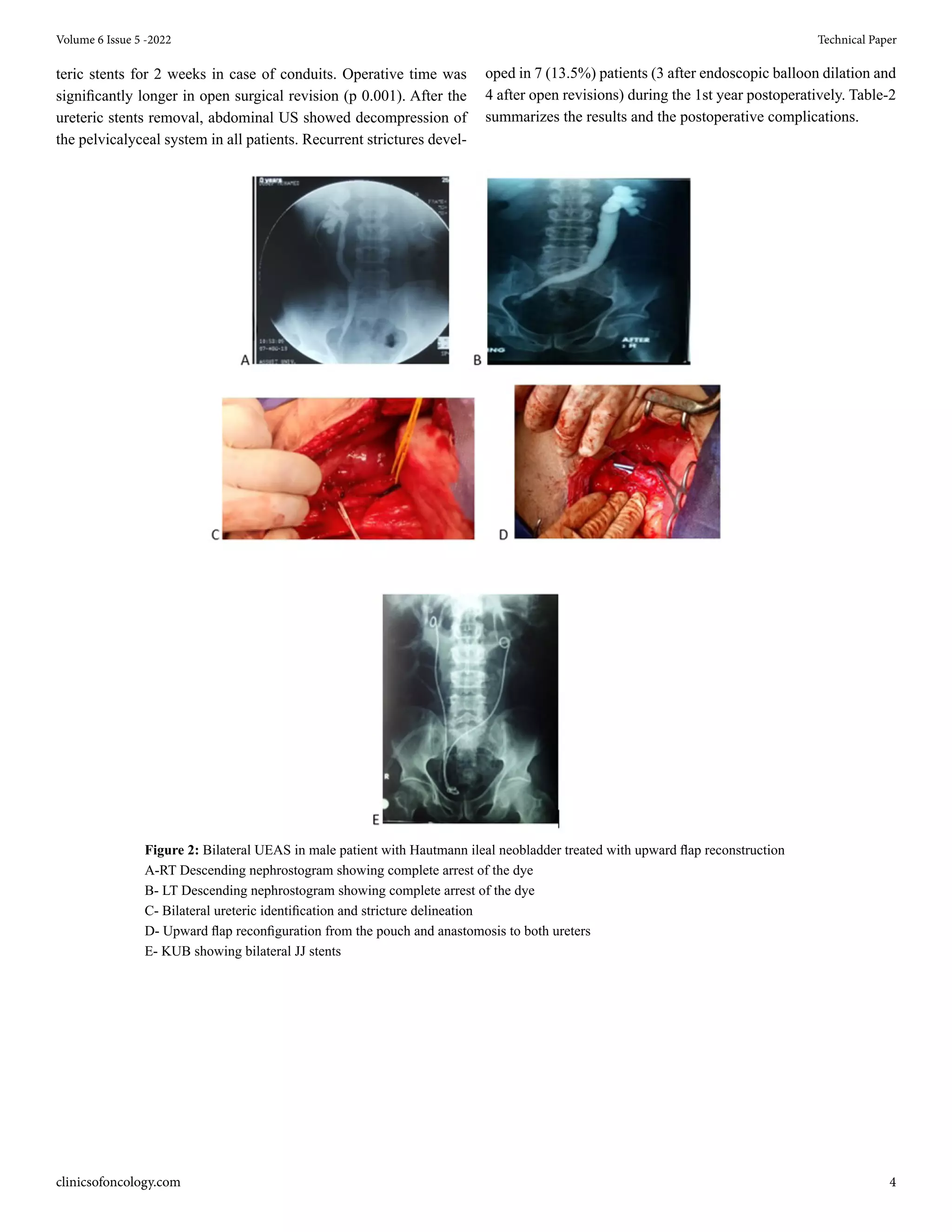 Uretero-Enteric Anastomosis Stricture after Urinary Diversion; Detailed Analysis of The ...