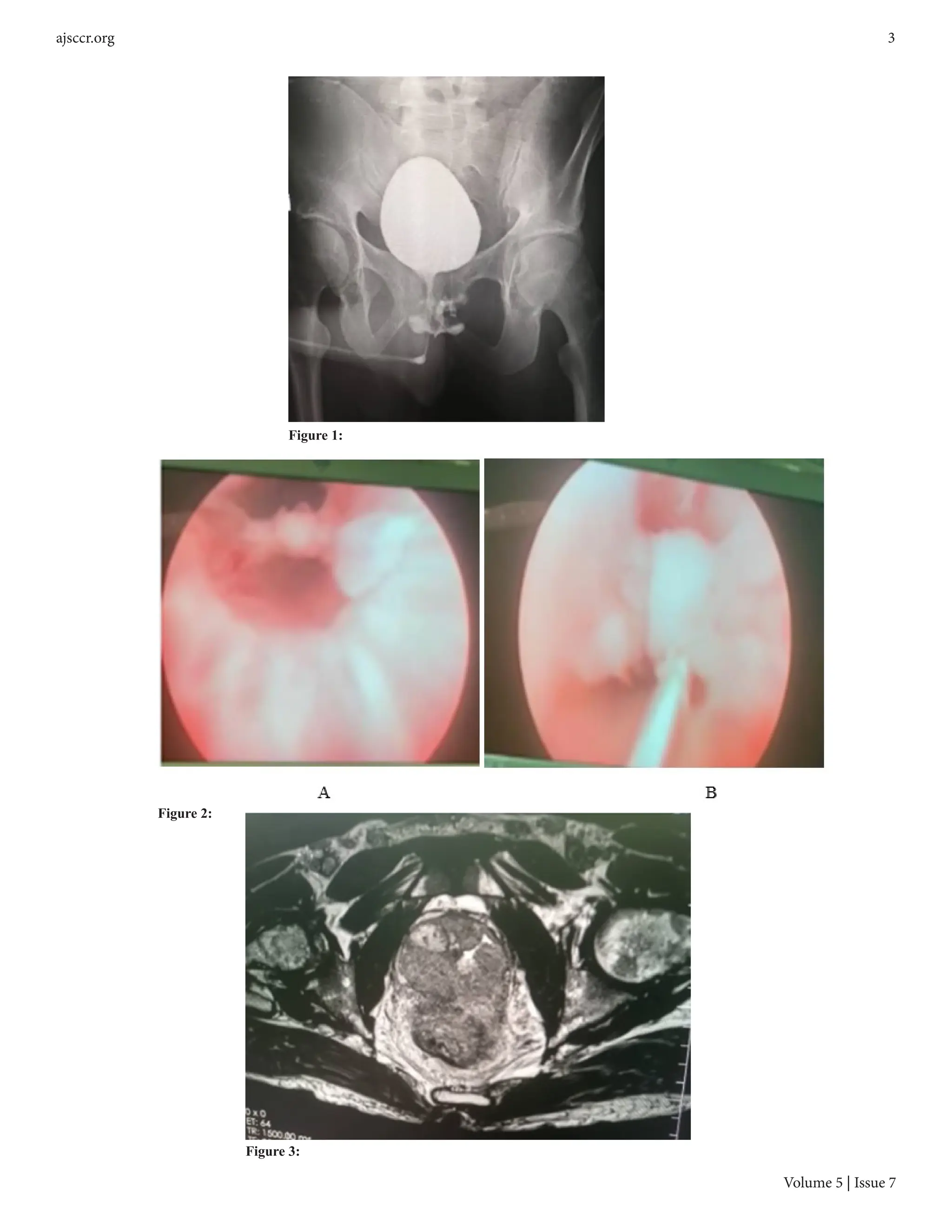 Spontaneous Tubercular Recto-Prostatic Urethral Fistula, A Rare ...