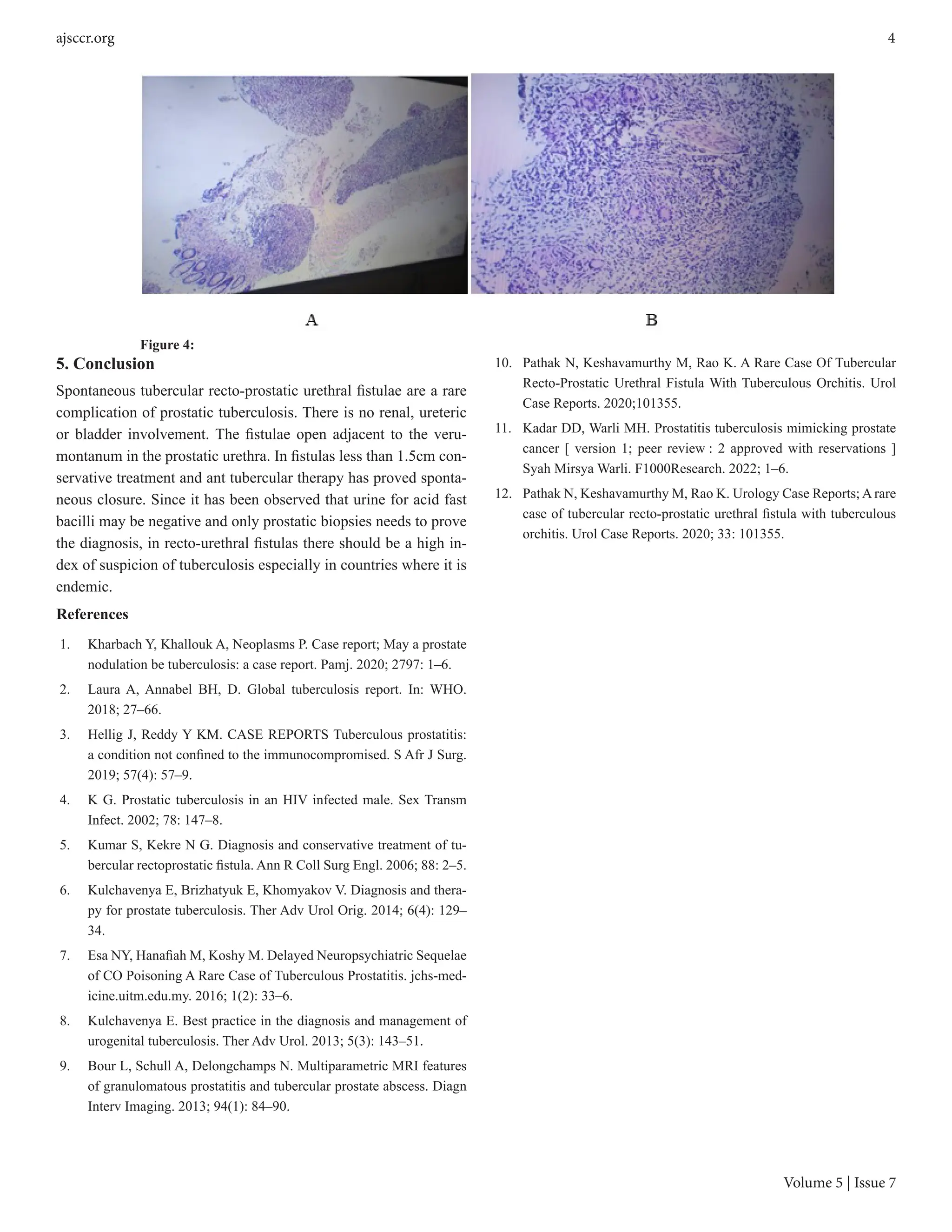Spontaneous Tubercular Recto-Prostatic Urethral Fistula, A Rare ...