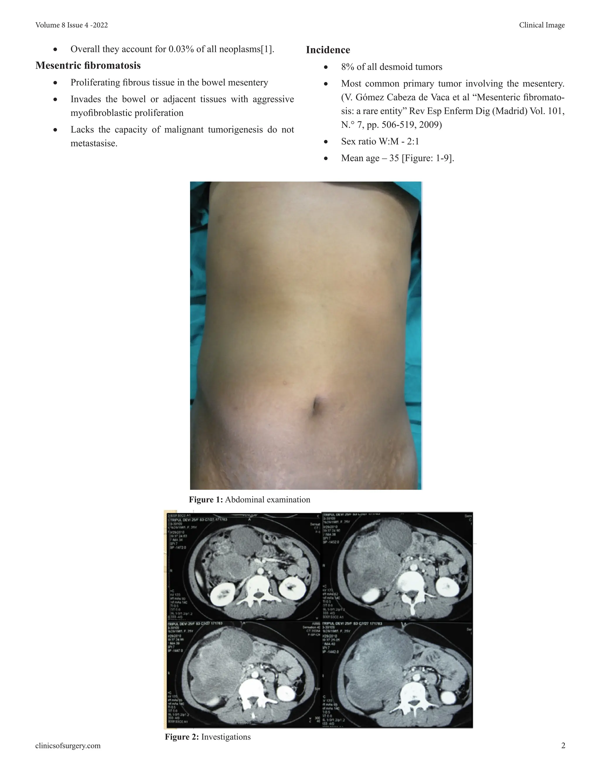 Unusual Cause of Abdominal Lump | PDF